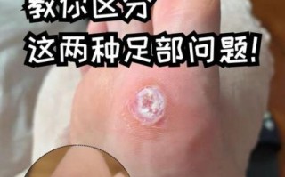 鸡眼会传染吗_鸡眼和跖疣区别