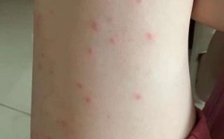 过敏性皮疹多久能好_过敏性皮疹会传染吗