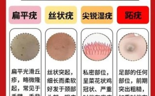菜花疣是什么原因造成的_菜花疣是怎么引起的