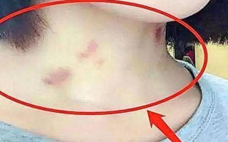 草莓印怎么快速消除_草莓印多久能消