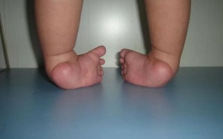 马蹄足是什么病_马蹄足能治好吗