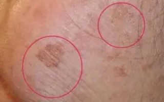 内分泌失调脸上长斑怎么调理_吃什么调理