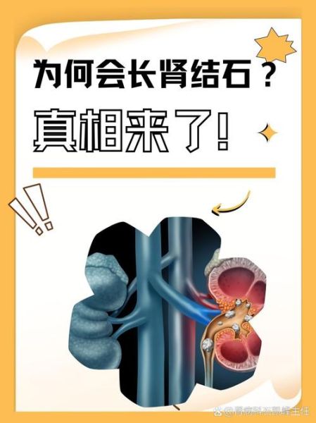 男人肾结石会影响性功能吗_肾结石会导致阳痿吗-第3张图片-山城妙识 男人肾结石会影响性功能吗_肾结石会导致阳痿吗-第3张图片-山城妙识