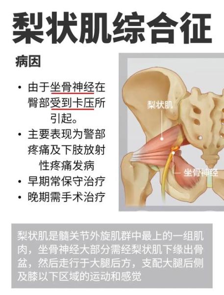 梨状肌位置在哪_梨状肌疼痛怎么缓解-第2张图片-山城妙识 梨状肌位置在哪_梨状肌疼痛怎么缓解-第2张图片-山城妙识