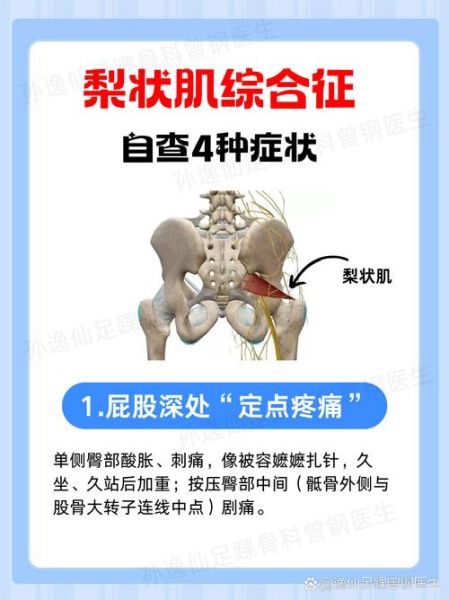 梨状肌位置在哪_梨状肌疼痛怎么缓解-第3张图片-山城妙识 梨状肌位置在哪_梨状肌疼痛怎么缓解-第3张图片-山城妙识