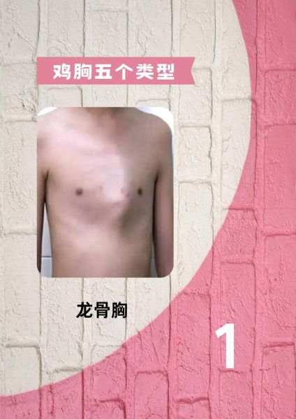 鸡胸会影响寿命吗_鸡胸的人寿命有多长-第1张图片-山城妙识 鸡胸会影响寿命吗_鸡胸的人寿命有多长-第1张图片-山城妙识