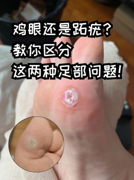 鸡眼会传染吗_鸡眼和跖疣区别-第1张图片-山城妙识 鸡眼会传染吗_鸡眼和跖疣区别-第1张图片-山城妙识