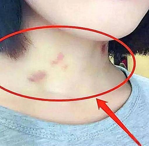 种草莓的危害_草莓印多久能消-第1张图片-山城妙识 种草莓的危害_草莓印多久能消-第1张图片-山城妙识