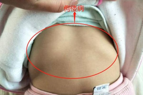 轻微佝偻病图片_早期症状识别-第1张图片-山城妙识 轻微佝偻病图片_早期症状识别-第1张图片-山城妙识