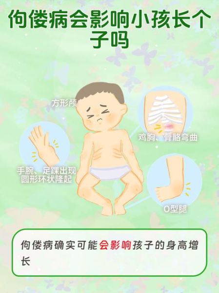 轻微佝偻病图片_早期症状识别-第3张图片-山城妙识 轻微佝偻病图片_早期症状识别-第3张图片-山城妙识