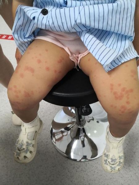 过敏性皮疹多久能好_过敏性皮疹会传染吗-第2张图片-山城妙识 过敏性皮疹多久能好_过敏性皮疹会传染吗-第2张图片-山城妙识