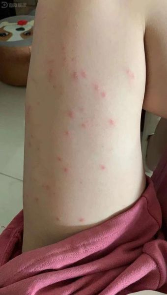 过敏性皮疹多久能好_过敏性皮疹会传染吗-第1张图片-山城妙识 过敏性皮疹多久能好_过敏性皮疹会传染吗-第1张图片-山城妙识
