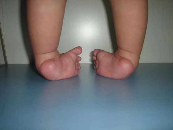 马蹄足是什么病_马蹄足能治好吗-第1张图片-山城妙识 马蹄足是什么病_马蹄足能治好吗-第1张图片-山城妙识