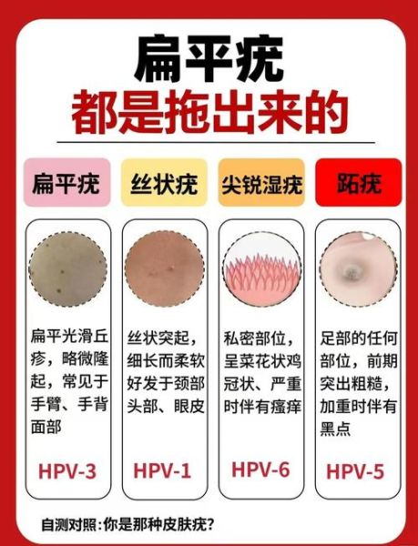 菜花疣是什么原因造成的_菜花疣是怎么引起的-第1张图片-山城妙识 菜花疣是什么原因造成的_菜花疣是怎么引起的-第1张图片-山城妙识