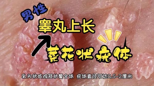 菜花疣是什么原因造成的_菜花疣是怎么引起的-第3张图片-山城妙识 菜花疣是什么原因造成的_菜花疣是怎么引起的-第3张图片-山城妙识