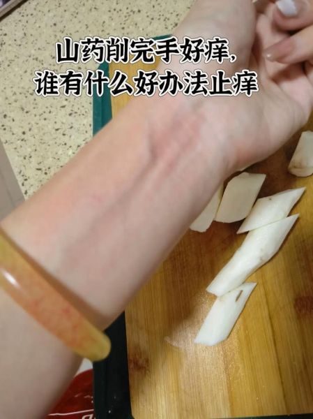 山药痒手怎么办_最有效方法-第1张图片-山城妙识 山药痒手怎么办_最有效方法-第1张图片-山城妙识