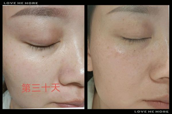 雀斑怎么淡化_雀斑图片对比-第1张图片-山城妙识 雀斑怎么淡化_雀斑图片对比-第1张图片-山城妙识