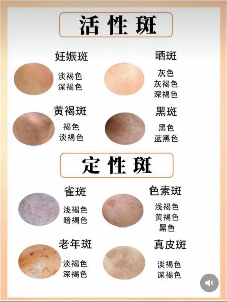 雀斑怎么淡化_雀斑图片对比-第3张图片-山城妙识 雀斑怎么淡化_雀斑图片对比-第3张图片-山城妙识