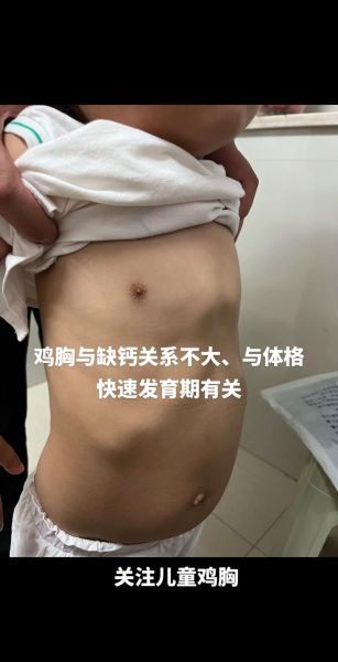 佝偻病鸡胸症状图片_佝偻病鸡胸能治好吗-第1张图片-山城妙识