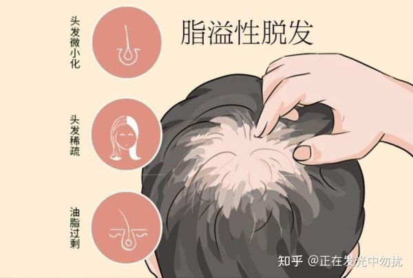 脱发怎么治疗效果好_脱发怎么恢复发量-第2张图片-山城妙识
