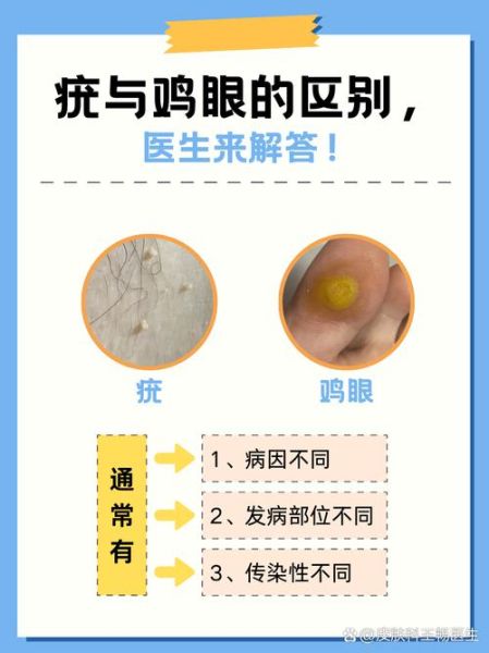 鸡眼初期症状图片_鸡眼和跖疣区别图解-第3张图片-山城妙识 鸡眼初期症状图片_鸡眼和跖疣区别图解-第3张图片-山城妙识
