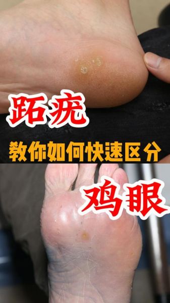 鸡眼初期症状图片_鸡眼和跖疣区别图解-第1张图片-山城妙识 鸡眼初期症状图片_鸡眼和跖疣区别图解-第1张图片-山城妙识