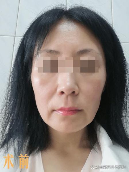 拉皮手术失败图片_如何避免拉皮失败-第1张图片-山城妙识 拉皮手术失败图片_如何避免拉皮失败-第1张图片-山城妙识