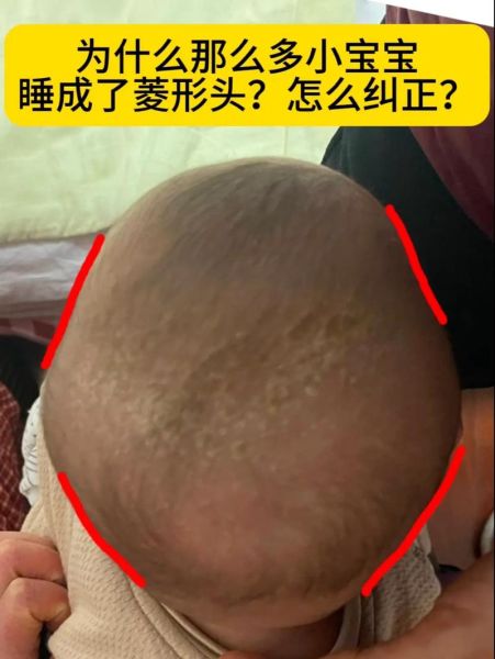 婴儿佝偻病睡姿图片_佝偻病宝宝正确睡姿-第1张图片-山城妙识 婴儿佝偻病睡姿图片_佝偻病宝宝正确睡姿-第1张图片-山城妙识